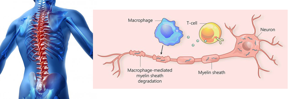 I couldn’t wiggle a finger. Myelin Sheath Spinal Cord Researcher Bob ...